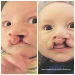 Our Cleft Journey: The NAM Device - Troubleshooting Motherhood